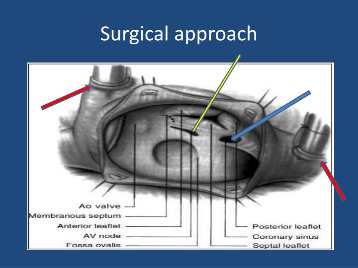 PPT - Tricuspid Valve Disease PowerPoint Presentation - ID:1902037