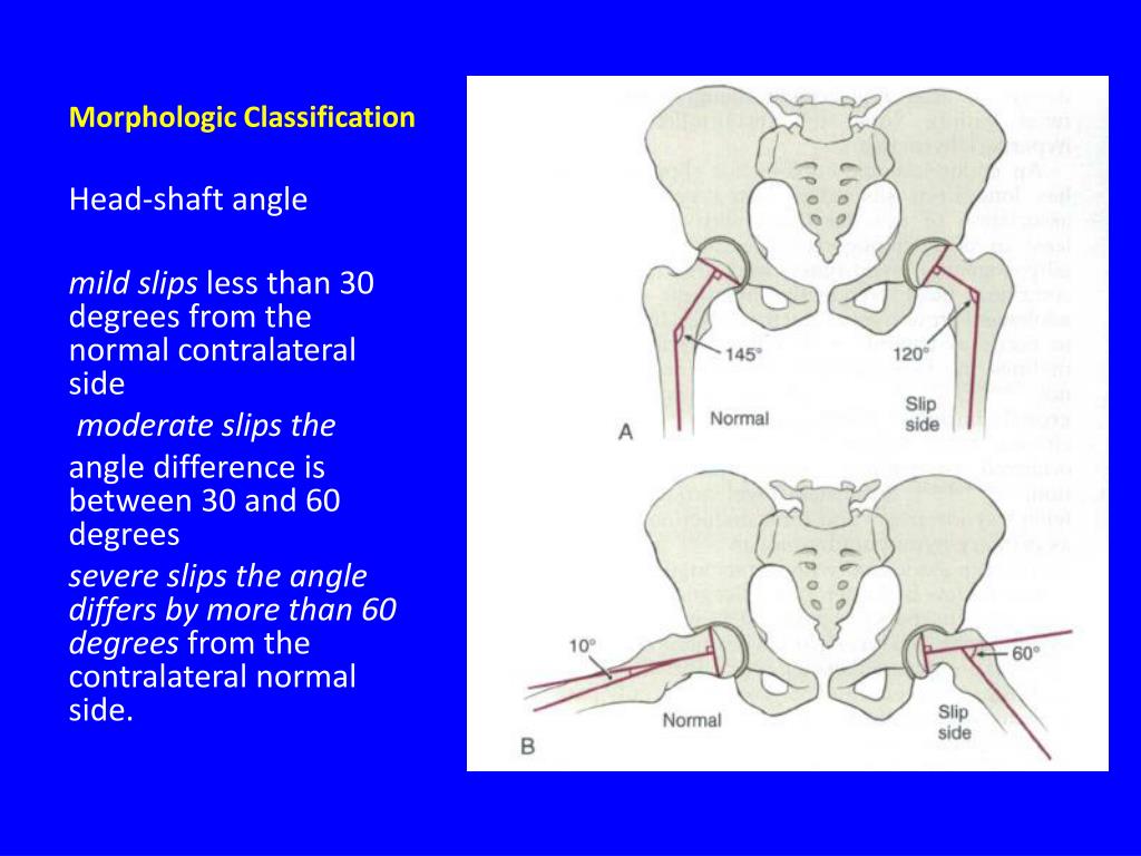 PPT - Slipped Capital Femoral Epiphysis SCFE PowerPoint Presentation ...