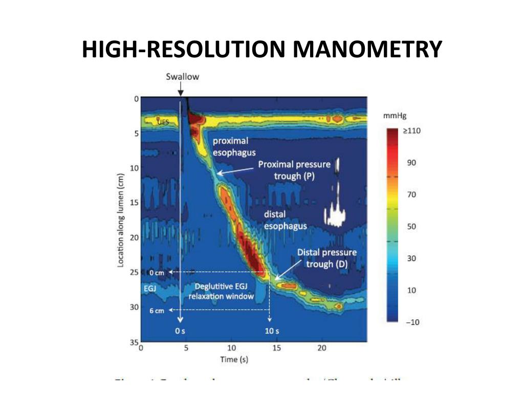 PPT - MOTILITY DISORDERS OF UPPER GI TRACT ACHALASIA GASTROPARESIS ...