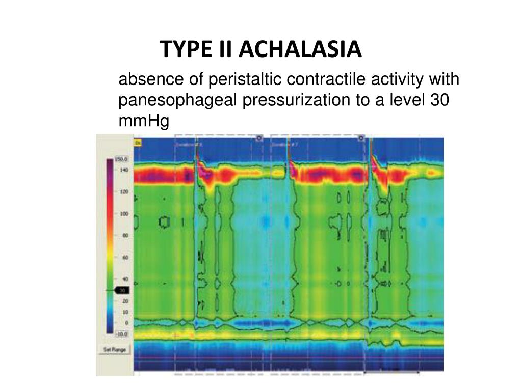 PPT - MOTILITY DISORDERS OF UPPER GI TRACT ACHALASIA GASTROPARESIS ...