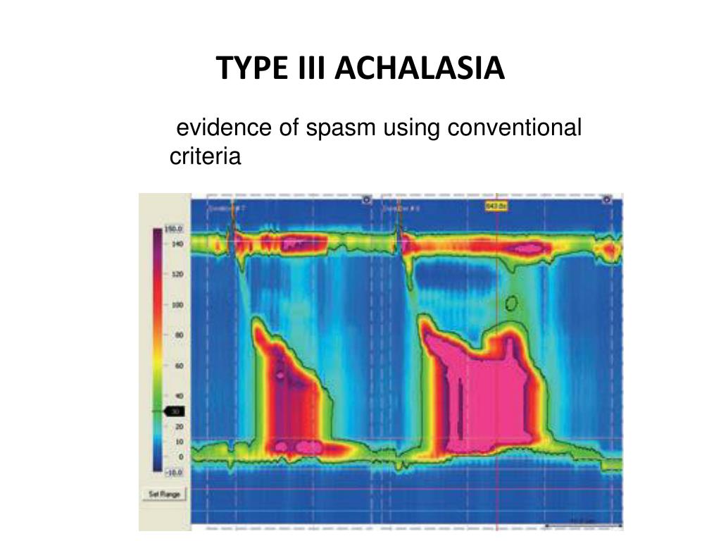 PPT - MOTILITY DISORDERS OF UPPER GI TRACT ACHALASIA GASTROPARESIS ...