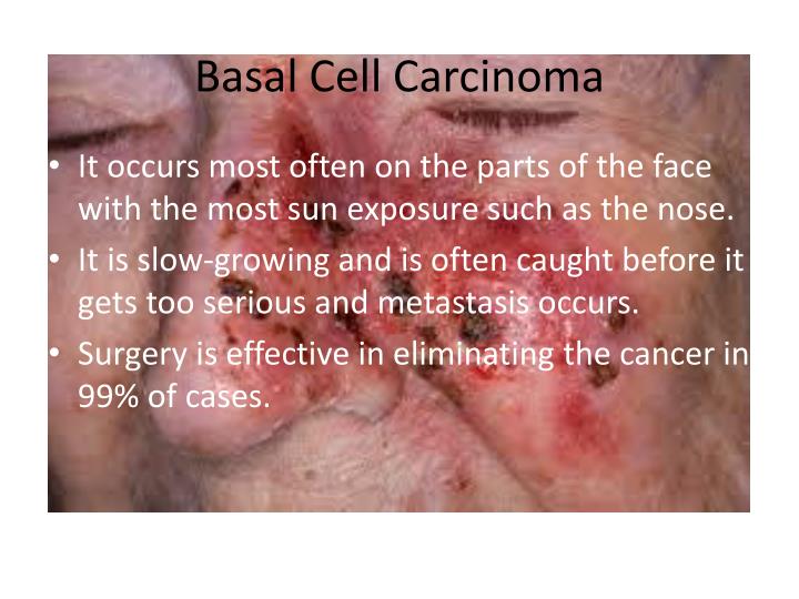 PPT - Sun Exposure/Skin Cancer PowerPoint Presentation - ID:1910524