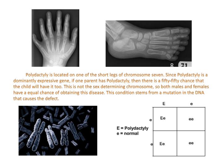 PPT - Polydactyly By: Jessica Howland PowerPoint Presentation - ID:1910567