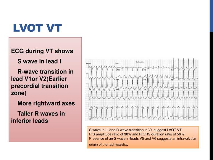 PPT - VENTRICULAR TACHYCARDIAS IN THE ABSENCE OF STRUCTURAL HEART ...