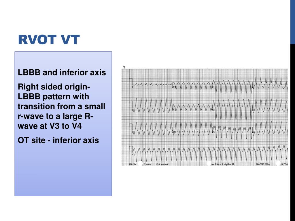 PPT - VENTRICULAR TACHYCARDIAS IN THE ABSENCE OF STRUCTURAL HEART ...