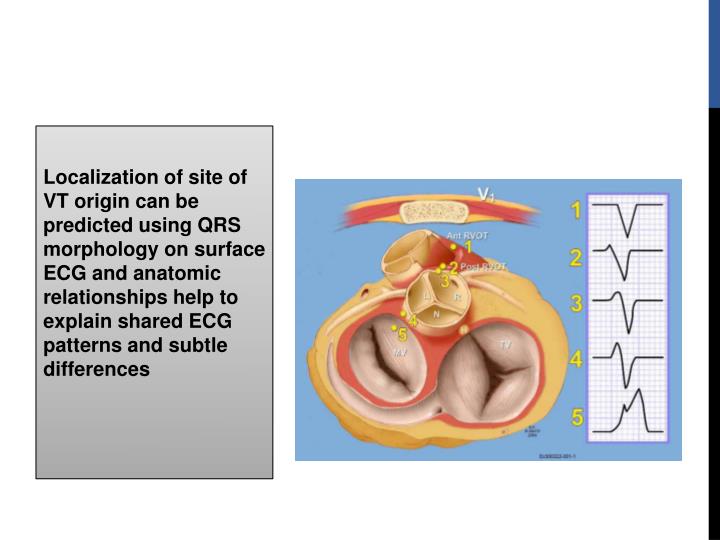 PPT - VENTRICULAR TACHYCARDIAS IN THE ABSENCE OF STRUCTURAL HEART ...
