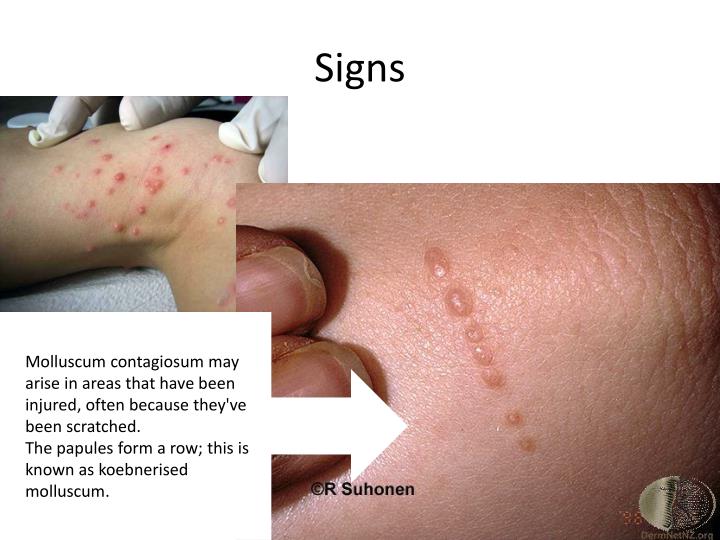 PPT - Molluscum Contagiosum PowerPoint Presentation - ID:1912202