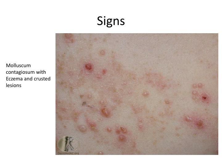 PPT - Molluscum Contagiosum PowerPoint Presentation - ID:1912202
