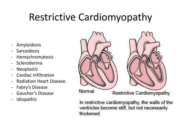 Ppt Cardiomyopathies Powerpoint Presentation Id 1914272