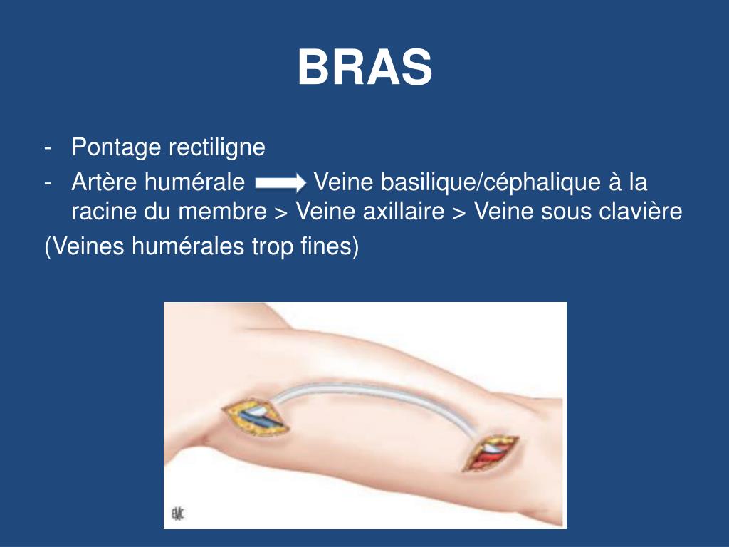 PPT - HÉMODIALYSE: PONTAGES AUX MEMBRES SUPÉRIEURS PowerPoint ...