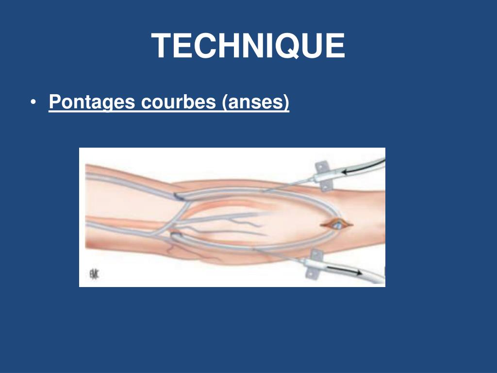 PPT - HÉMODIALYSE: PONTAGES AUX MEMBRES SUPÉRIEURS PowerPoint ...