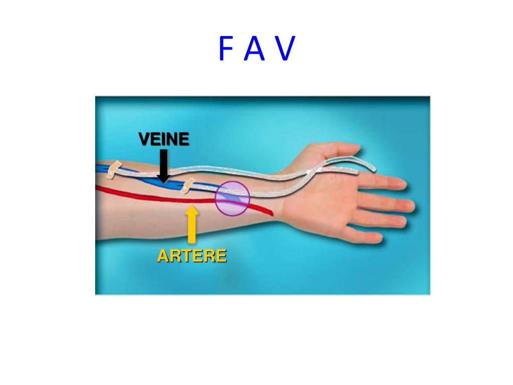 PPT - Abords Vasculaires pour Hémodialyse PowerPoint Presentation, free ...