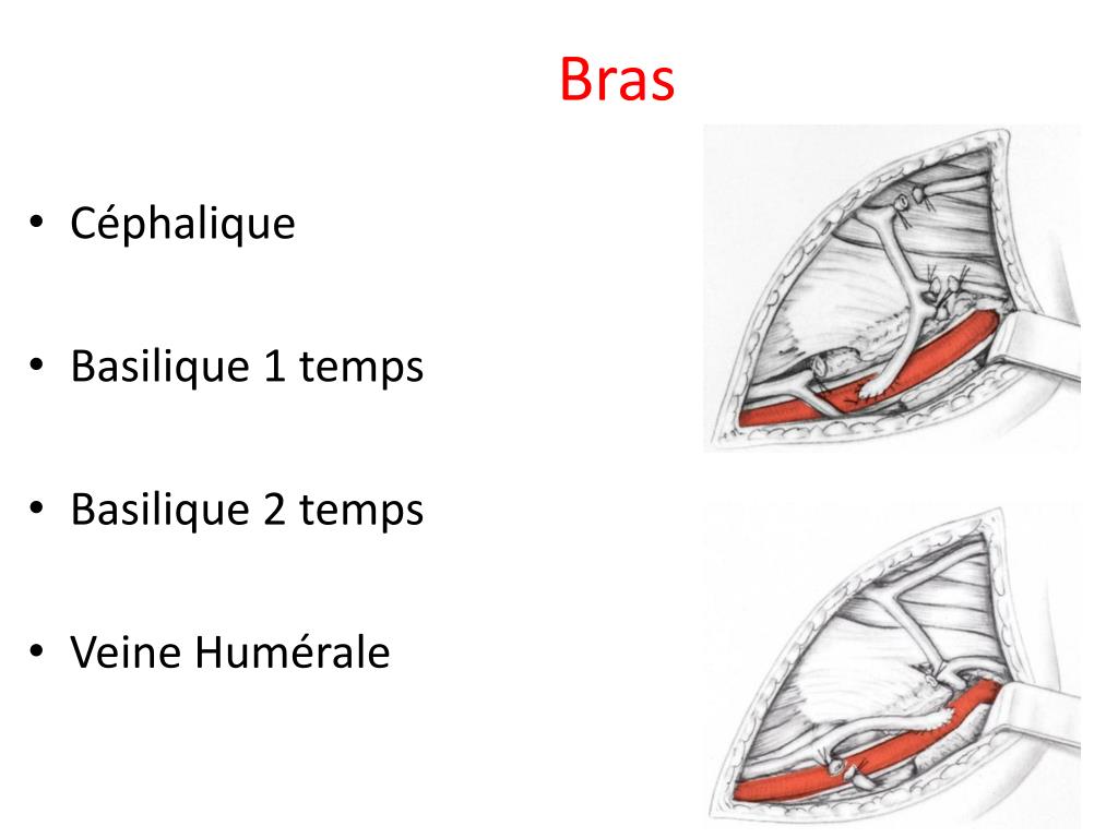PPT - Abords Vasculaires pour Hémodialyse PowerPoint Presentation, free ...