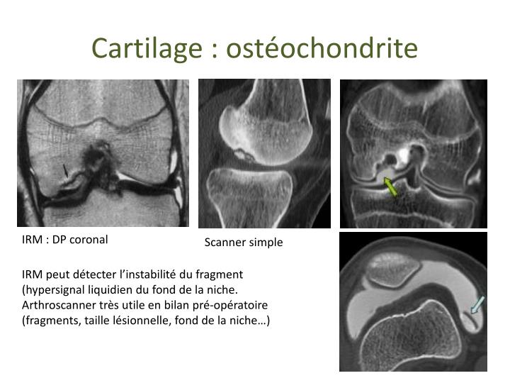 PPT - Imagerie du genou pour le rhumatologue PowerPoint Presentation ...