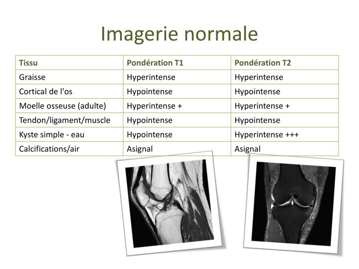 PPT - Imagerie du genou pour le rhumatologue PowerPoint Presentation ...