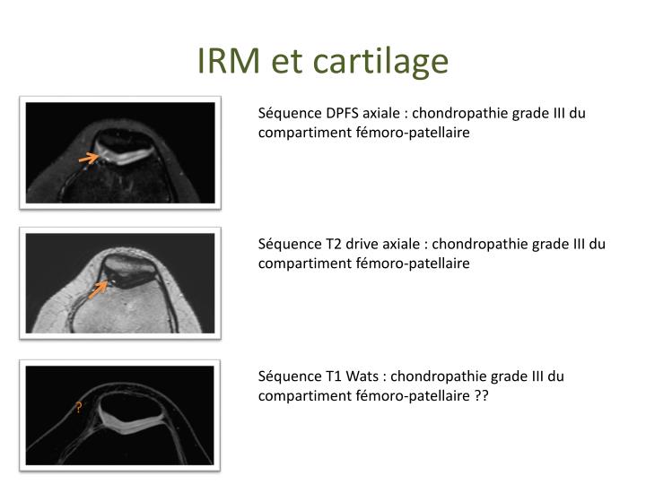 PPT - Imagerie du genou pour le rhumatologue PowerPoint Presentation ...