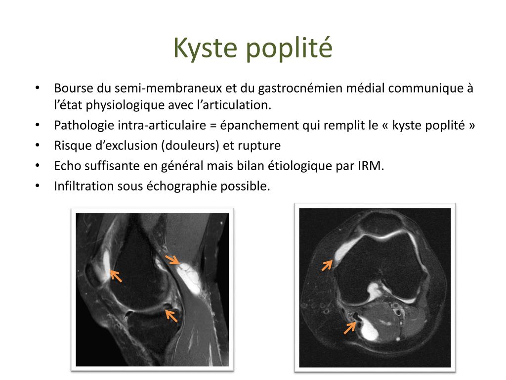 PPT - Imagerie du genou pour le rhumatologue PowerPoint Presentation ...
