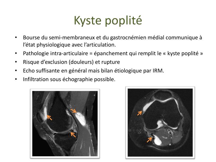 Kyste Poplité Guérit Seul: Kyste Genou – ZAZFEE