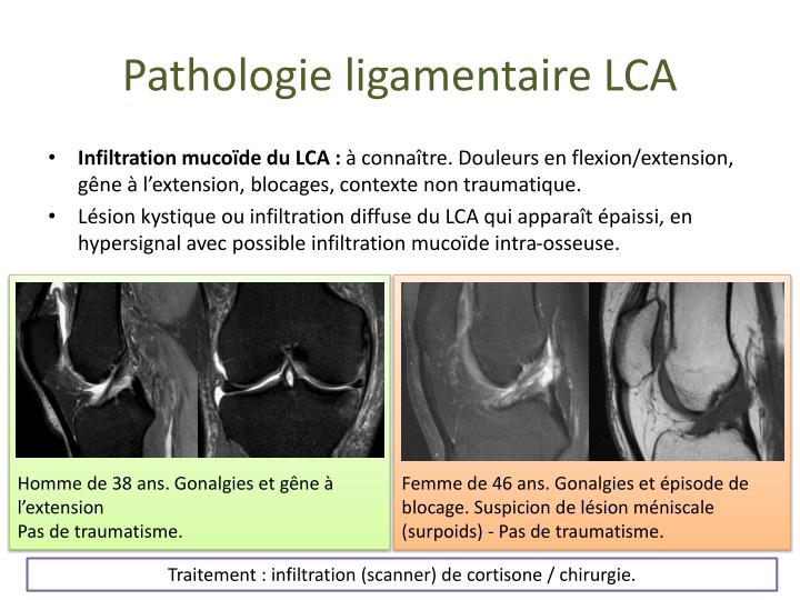 PPT - Imagerie du genou pour le rhumatologue PowerPoint Presentation ...