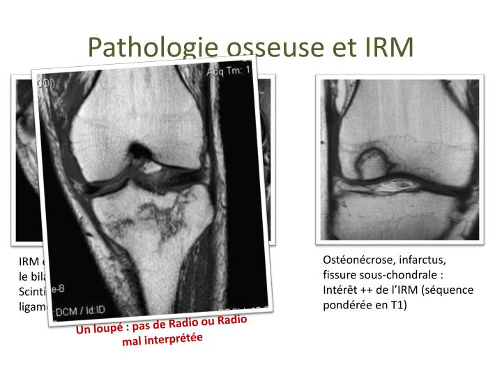 PPT - Imagerie du genou pour le rhumatologue PowerPoint Presentation ...