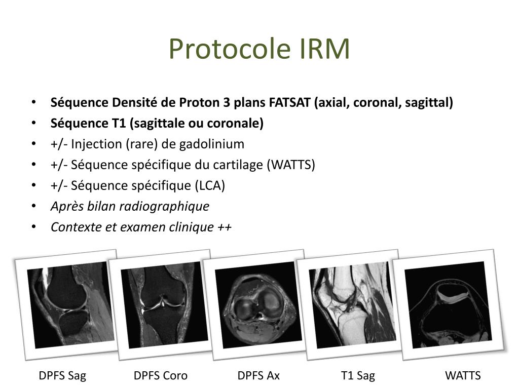 PPT - Imagerie du genou pour le rhumatologue PowerPoint Presentation ...