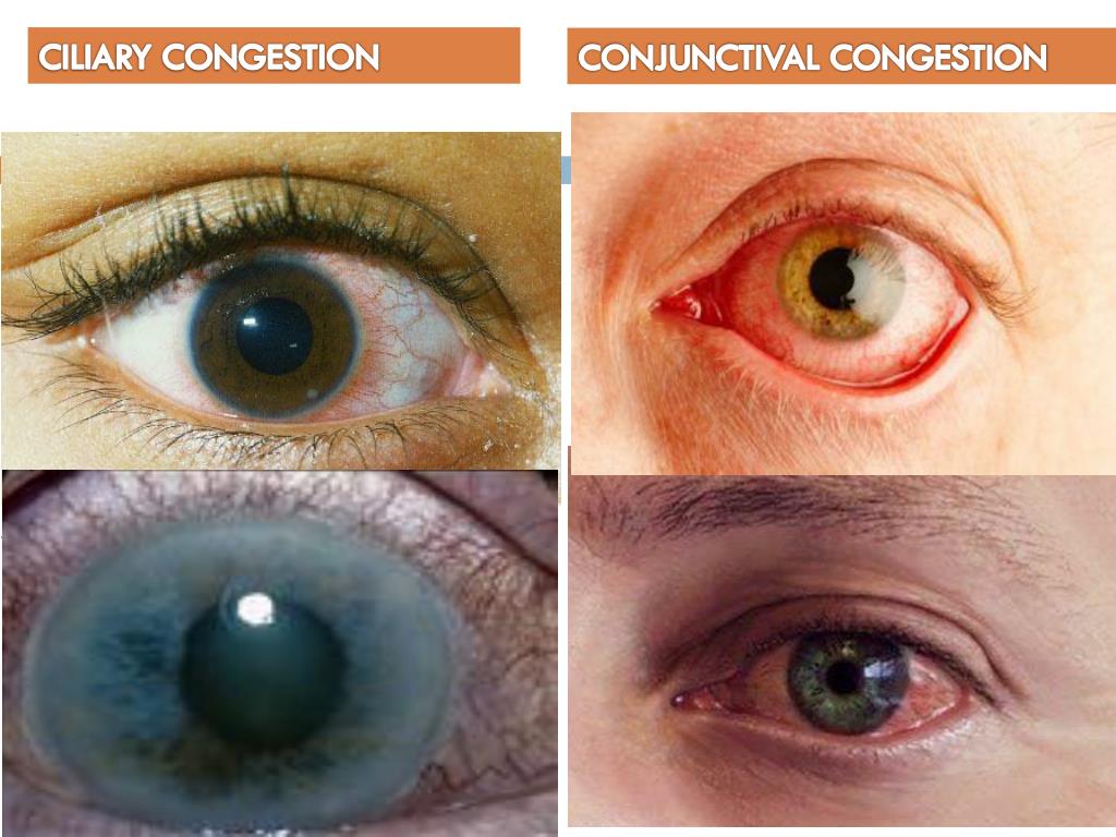 PPT - Review of clinical anatomy and physiology of the conjunctiva ...