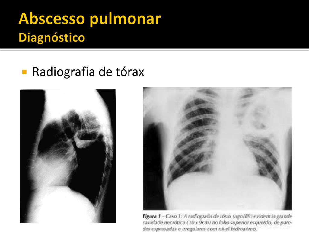PPT - Fisiopatologia e indicações cirúrgicas nas Infecções Pleuro ...