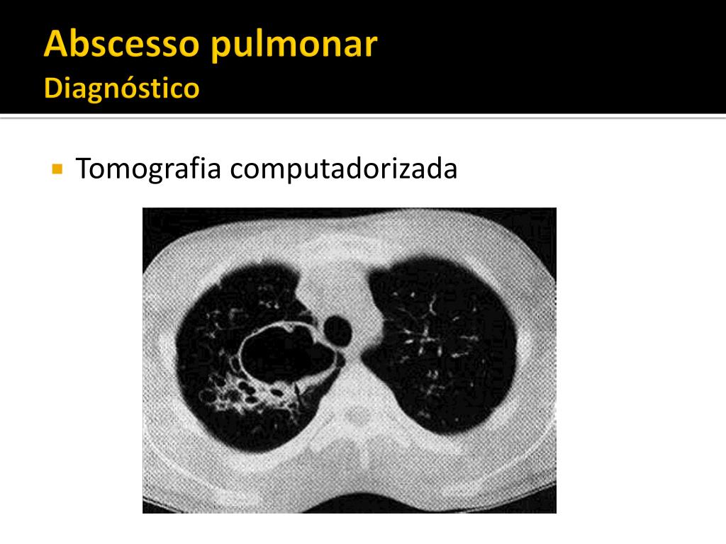 PPT - Fisiopatologia e indicações cirúrgicas nas Infecções Pleuro ...