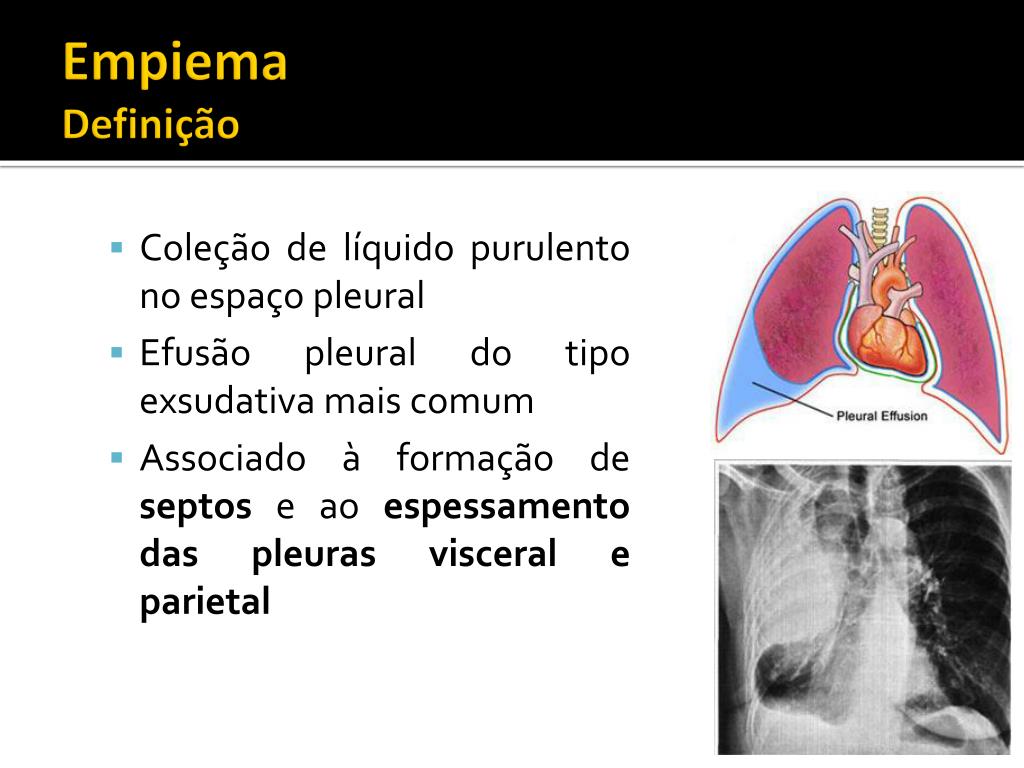 PPT - Fisiopatologia e indicações cirúrgicas nas Infecções Pleuro ...