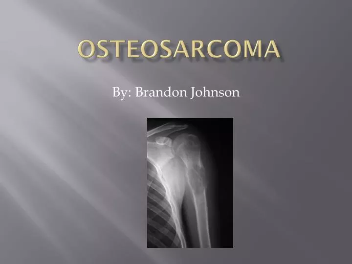PPT - osteosarcoma PowerPoint Presentation, free download - ID:1924403