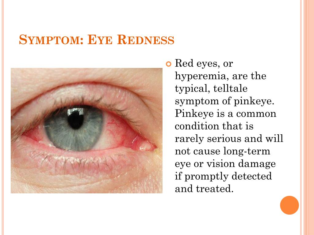 PPT - Pinkeye (Conjunctivitis) Slideshow: Causes, Symptoms ...