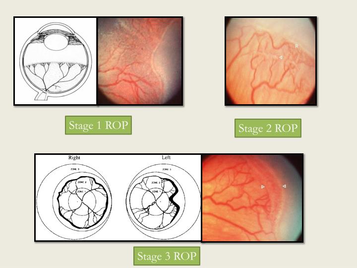 PPT - R etrolental Fibroplasia PowerPoint Presentation - ID:1930671