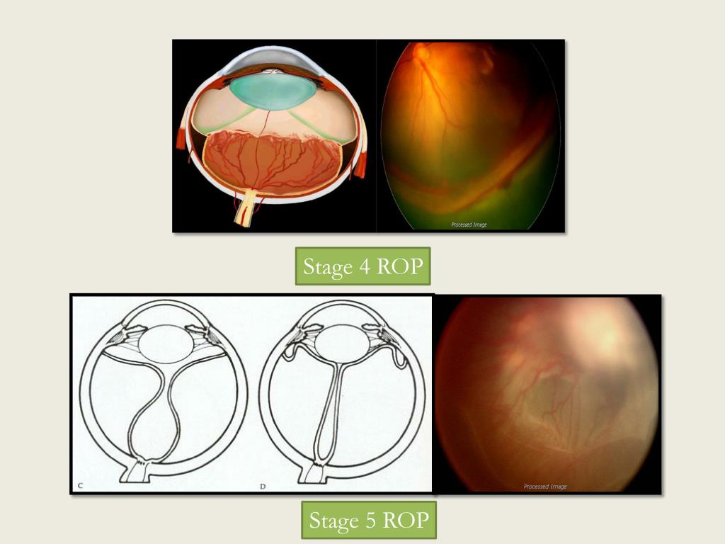 PPT - R etrolental Fibroplasia PowerPoint Presentation, free download ...