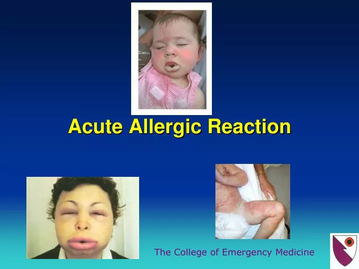 PPT - Acute Allergic Reaction PowerPoint Presentation, free download ...