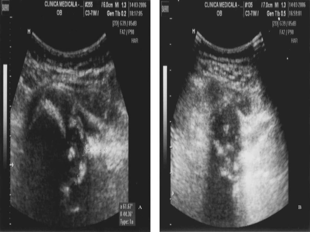 PPT - Luxatia congenitala a soldului PowerPoint Presentation, free ...