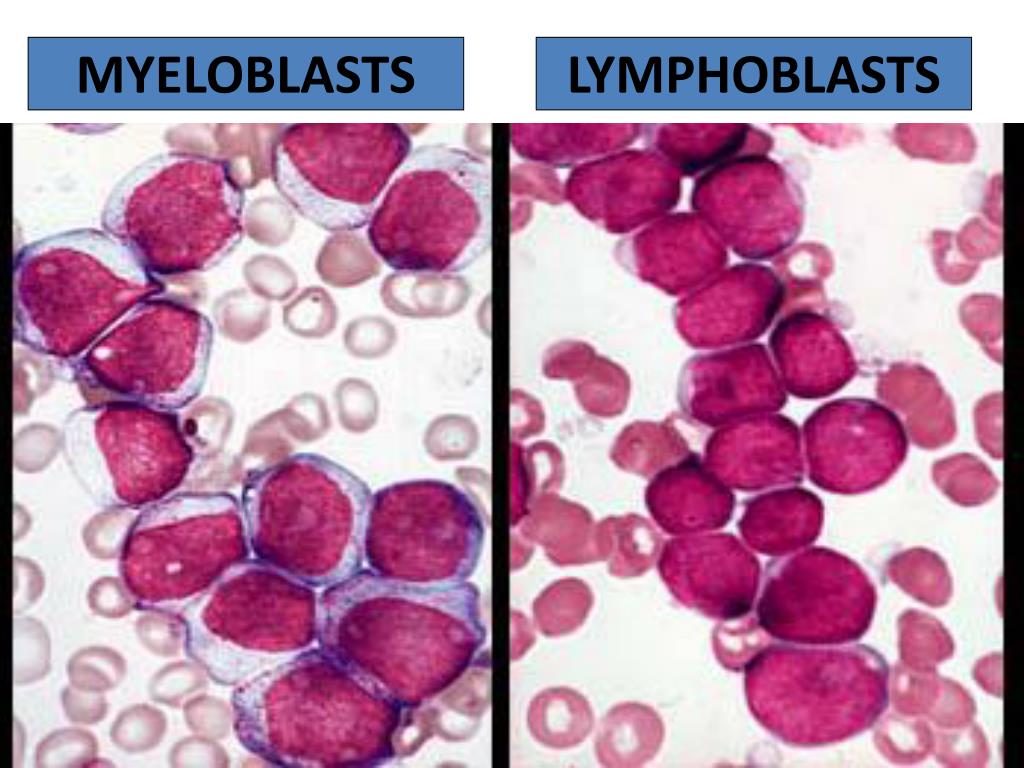 PPT - LEUKEMIAS Dr Mehboob Khan Pathologist PowerPoint Presentation ...