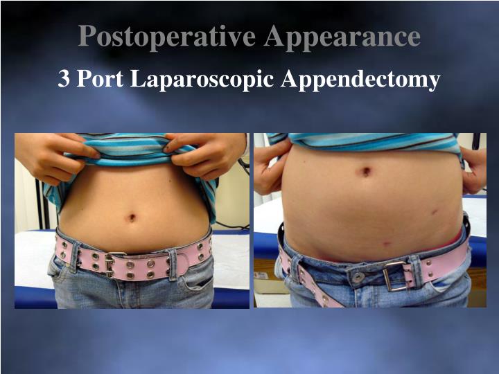 PPT - Current Management of Children with Appendicitis PowerPoint ...