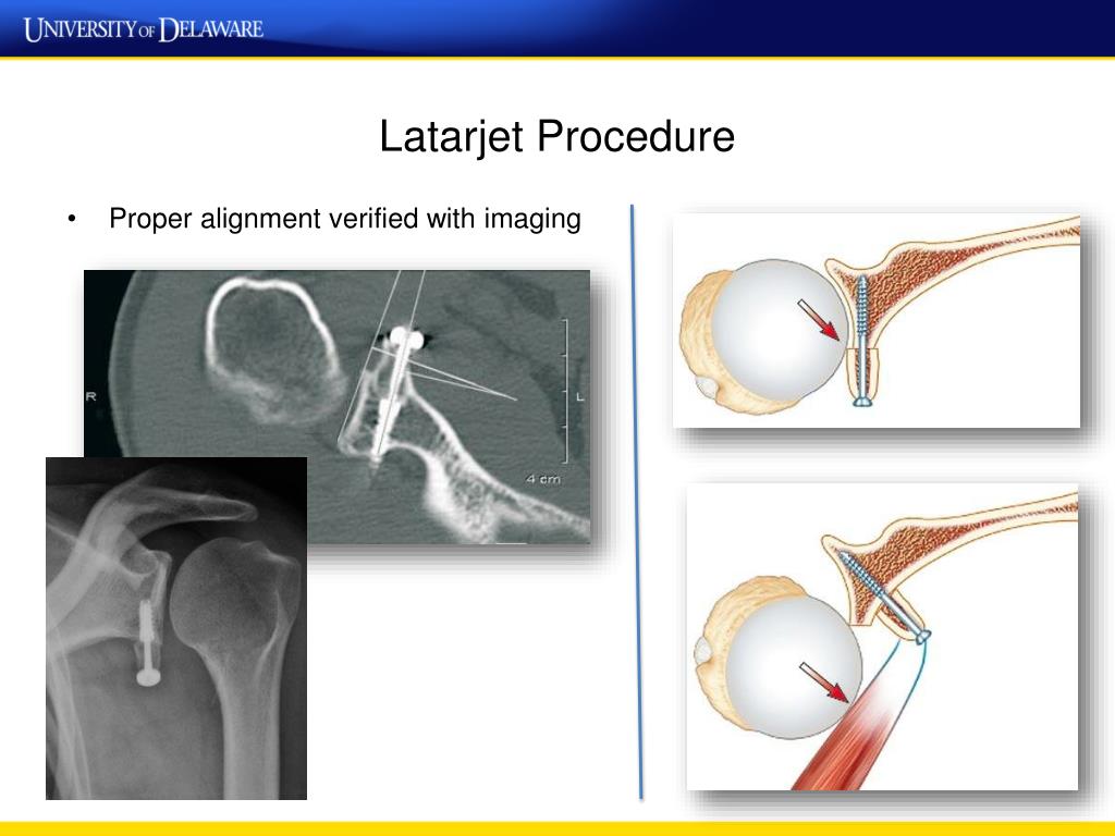 PPT - Chronic Shoulder Instability in X Games Athlete PowerPoint ...