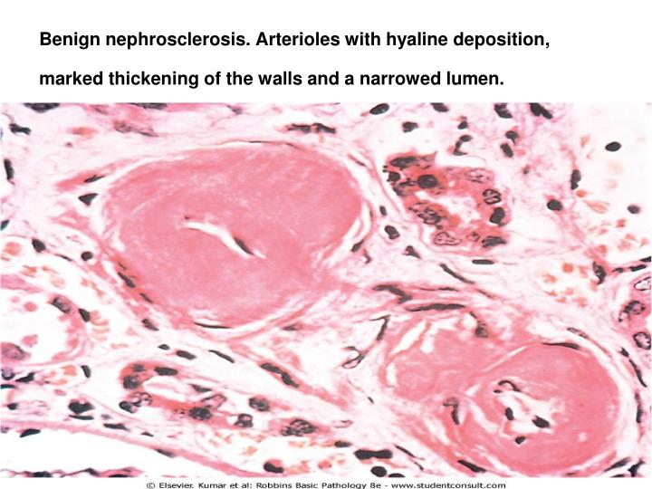 PPT - Benign Nephrosclerosis PowerPoint Presentation - ID:1936470
