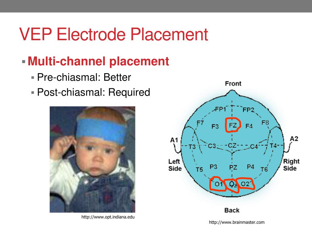 PPT - Clinical electrophysiology: PowerPoint Presentation, free ...