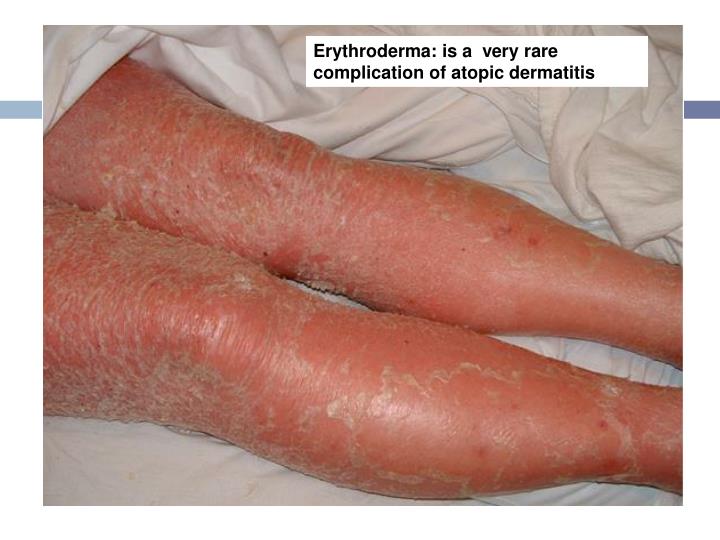PPT - Dermatitis and eczematous disorders PowerPoint Presentation - ID ...