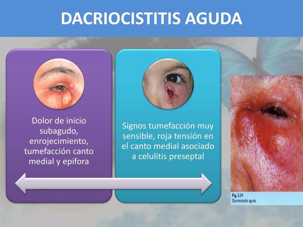 PPT - ENFERMEDADES DEL APARATO LAGRIMAL PowerPoint Presentation, free ...