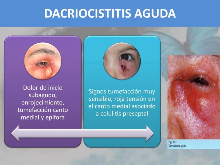 PPT - ENFERMEDADES DEL APARATO LAGRIMAL PowerPoint Presentation - ID ...