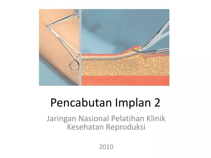 PPT - Pencabutan Implan 2 PowerPoint Presentation, free download - ID ...