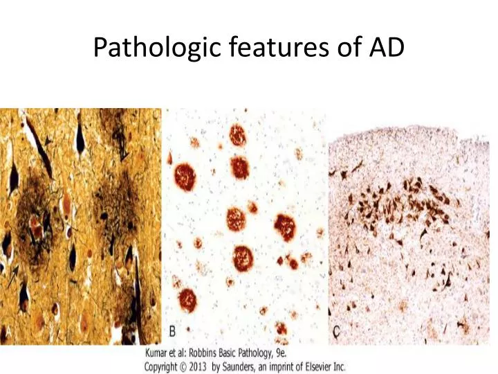 PPT - Pathologic features of AD PowerPoint Presentation, free download ...
