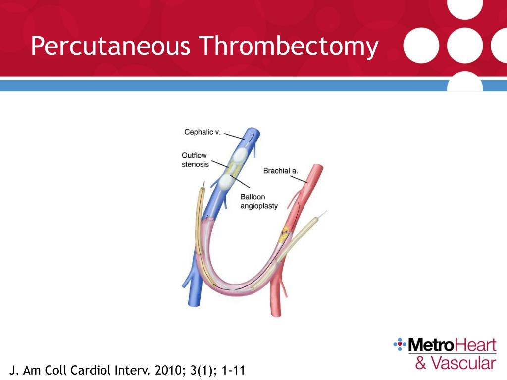 PPT - Arteriovenous Fistulas Types, Trends, Physical Examination ...