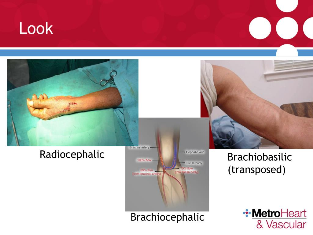 PPT - Arteriovenous Fistulas Types, Trends, Physical Examination ...
