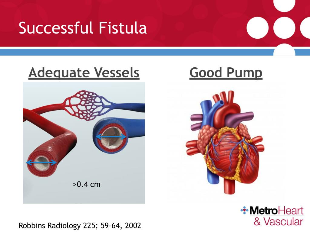 PPT - Arteriovenous Fistulas Types, Trends, Physical Examination ...