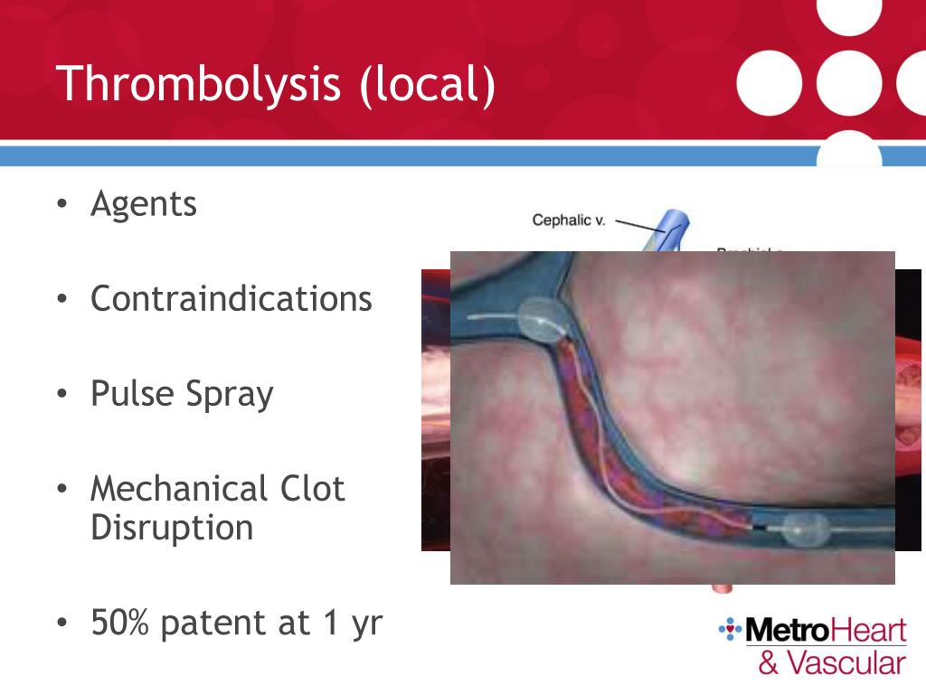 PPT - Arteriovenous Fistulas Types, Trends, Physical Examination ...