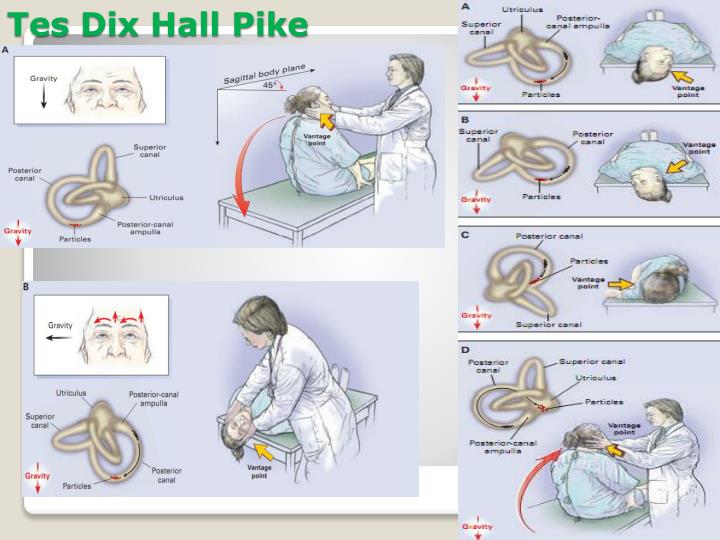 PPT - Benign Paroxysmal Positional Vertigo (BPPV) PowerPoint ...